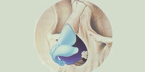 polyps in the nose - DR SAMI